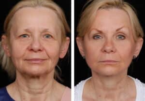 Fillers vs. Facelifts: Where Are the Boundaries? - David Hidalgo, MD FACS